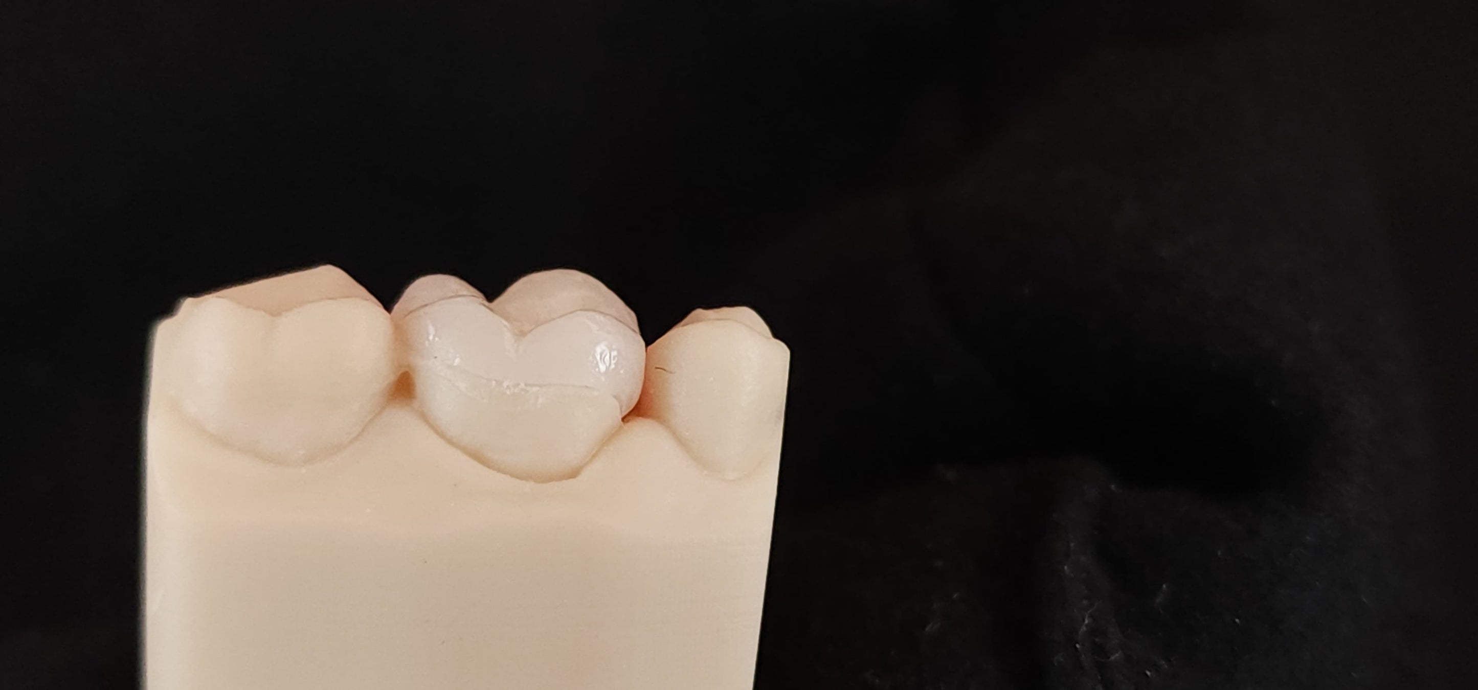 Custom Emax Inlays, Onlays & Overlays | ExoDent | Fast Delivery to UK