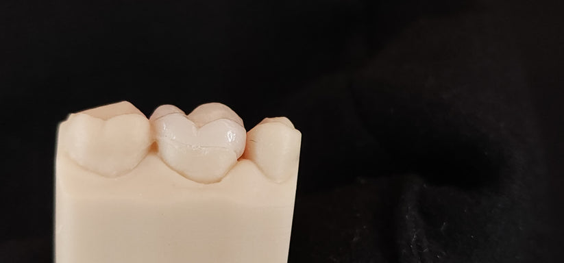 Custom Emax Inlays, Onlays & Overlays | ExoDent | Fast Delivery to UK