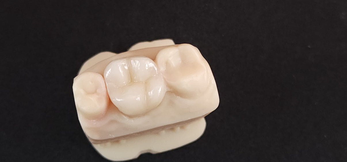 Custom Emax Inlays, Onlays & Overlays | ExoDent | Fast Delivery to UK