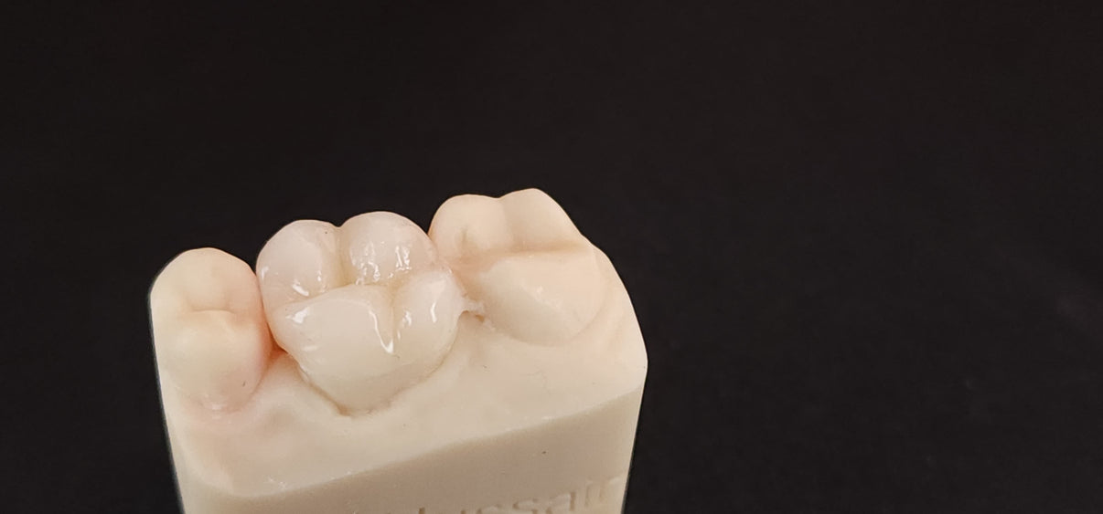 Custom Emax Inlays, Onlays & Overlays | ExoDent | Fast Delivery to UK